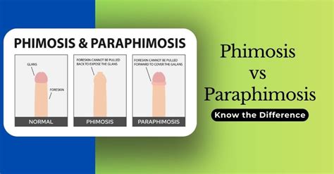 Best Foreskin Treatment In Gurugram Phimosis Vs Paraphimosis