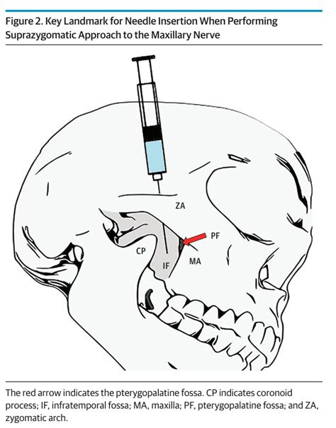 Maxillary Nerve Block Technique