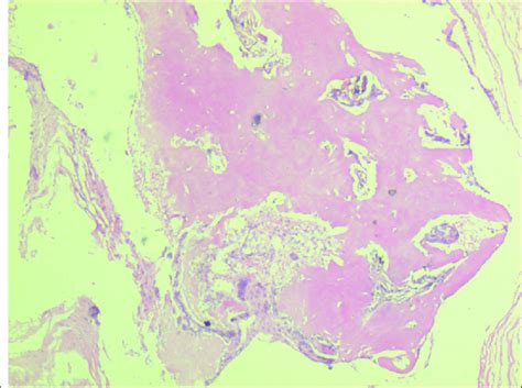 Histological Picture Showing Dentinoid Like Material With Minimal Pulp
