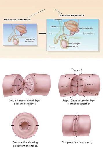 Vasectomy Stitches