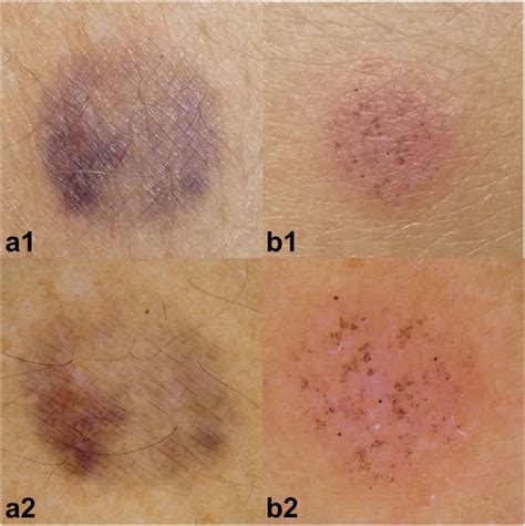 [translated Article] Dermoscopy In Patch Testing How Can It Help Actas Dermo Sifiliográficas