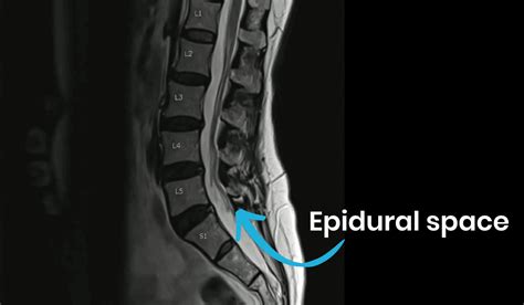 Caudal Epidural Spinal Injections What You Need To Know Ultrasound