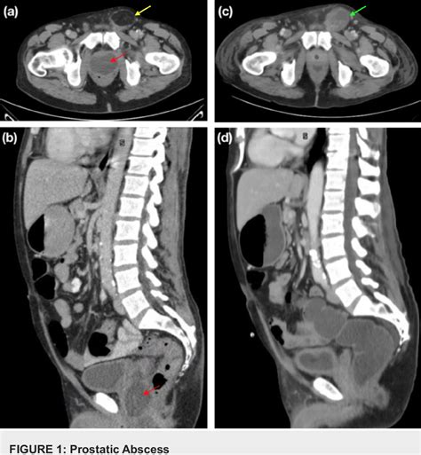 Figure 1 From An Unusual Presentation Of Prostatic Abscess Due To Actinomyces Turicensis And