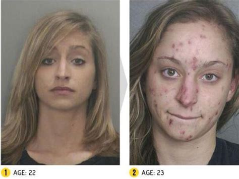 Drug Addiction Before And After Photos Show Shocking Reality Of