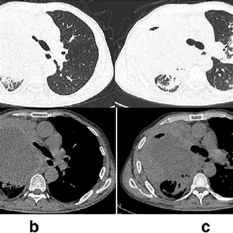 Thoracic Computed Tomography Ct Scan At Different Times A A Giant