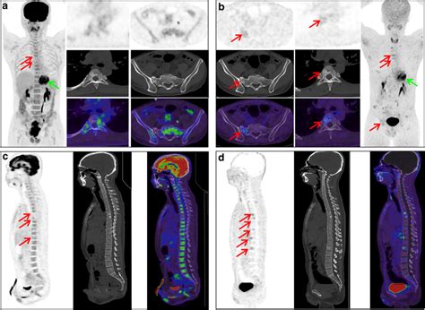 A 32 Year Old Man With Bone Metastases Of Gists The Gastric Stromal