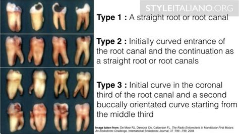The Radix Entomolaris Style Italiano Endodontics