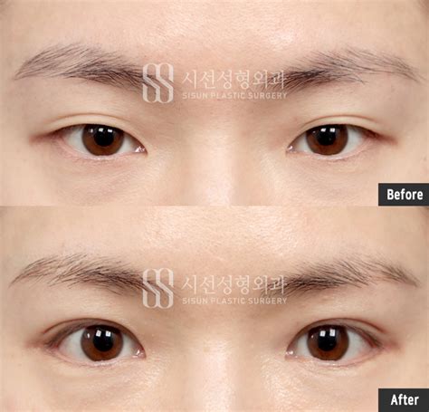 인라인쌍꺼풀 연예인은 누가 있을까 쌍꺼풀 종류와 특징 네이버 블로그