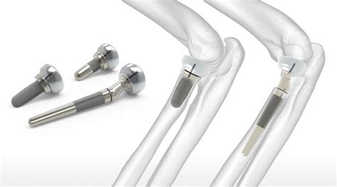 Anatomic Radial Head Solutions Radial Head Replacement System Medhold Medical