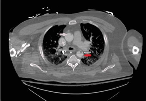 Computed Tomography Angiogram Cta Of The Chest Revealed Small Filling