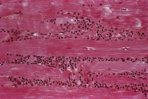 Rheumatoid Arthritis Stock Image M1100508 Science Photo Library