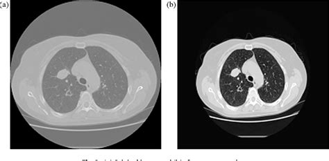 Figure 2 From Automatic Segmentation And Recognition Of Lungs And Lesion From Ct Scans Of Thorax