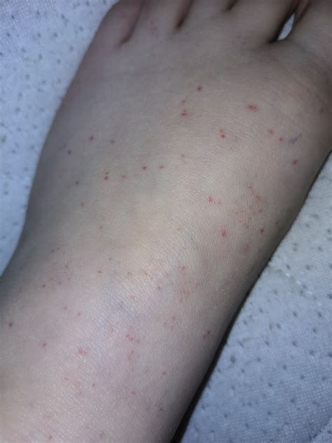 Красные пятна на ногах фото и названия