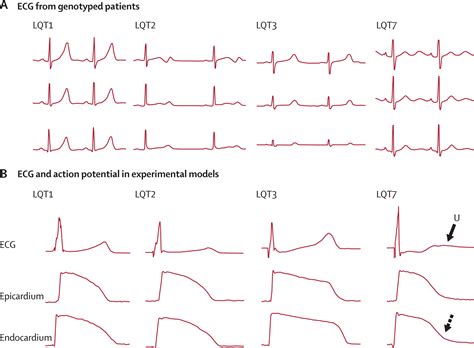 The Qt Syndromes Long And Short The Lancet The Qt Syndromes Long And Short The Lancet