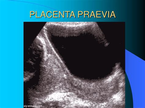 Ppt Localisation Placenta 3° Trimestre Powerpoint Presentation Free Download Id5670793