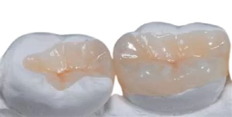 Top Crowns And Bridges Dental Clinic In Delhi Clinic Eximus