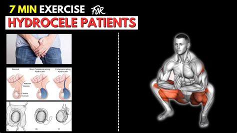 Simple Yoga And Exercise For Hydrocele Problem Youtube