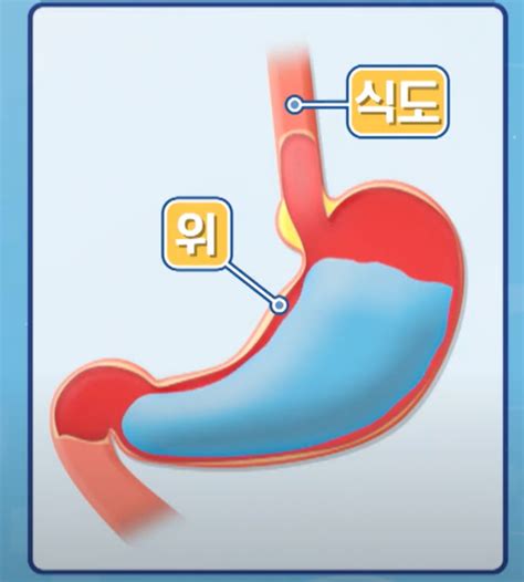 역류성 식도염 목 이물감 증상과 치료방법 Feat경험자의 후기