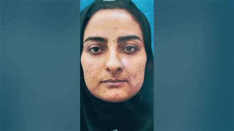 تصغير و تجميل الأنف دكتور ايرج وكيلي ايران مدينة مشهد واتساب