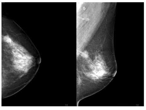 Nódulos Caracterización Y Categorización Gaceta Mexicana De Oncología