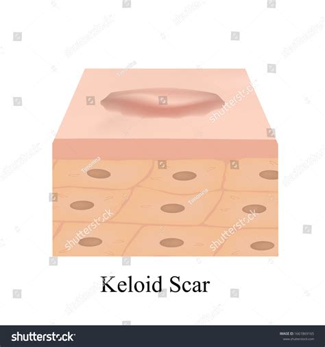Scars Keloid Anatomical Structure Skin Scar Stock Illustration 1661869165