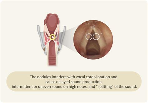 Vocal Cord Nodules Ohkz