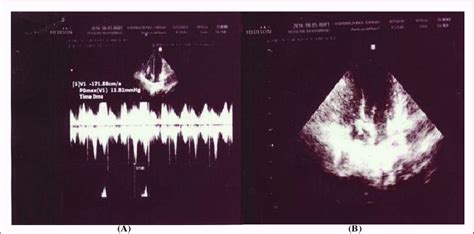 Small Vegetation Near To Septal Leaflets Of Tricuspid Valve M Mode