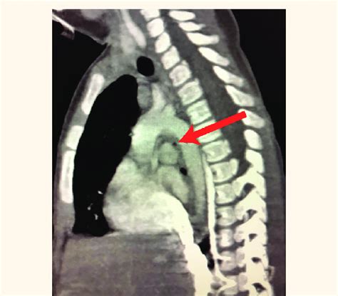 Sagittal Reformatted Computed Tomography Scan Of The Chest Of A