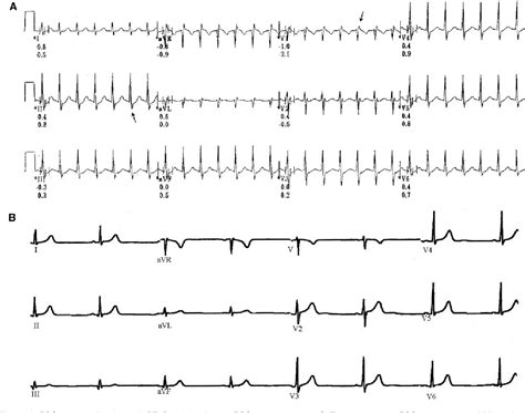 Supraventricular Arrhythmia Ecg Assessment Semantic Scholar