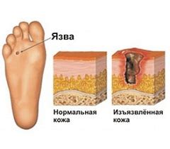 Трофическая язва на ногах - лечение