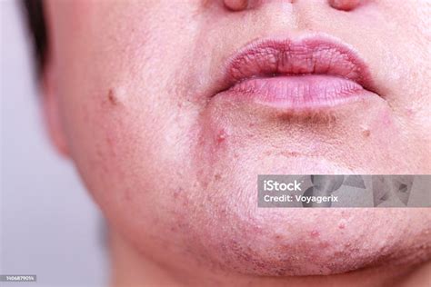 여드름 피부 문제를 가진 여성 얼굴 건조한에 대한 스톡 사진 및 기타 이미지 건조한 깨끗한 몸 가꾸기 Istock
