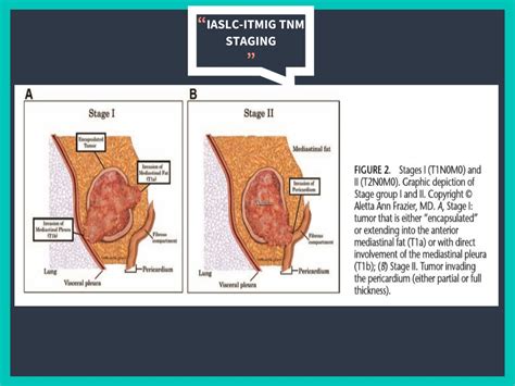 Ppt Approach To Anterior Mediastinal Mass Powerpoint Presentation