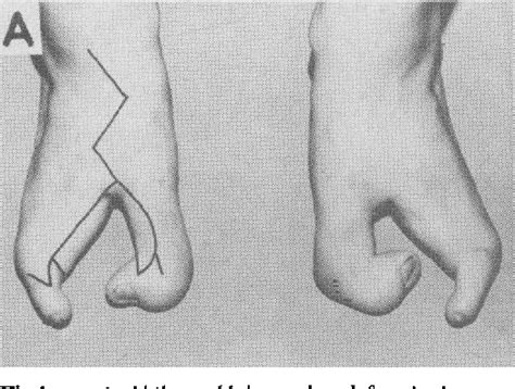 Figure 1 From Lobster Claw Deformities Of The Feet Semantic Scholar