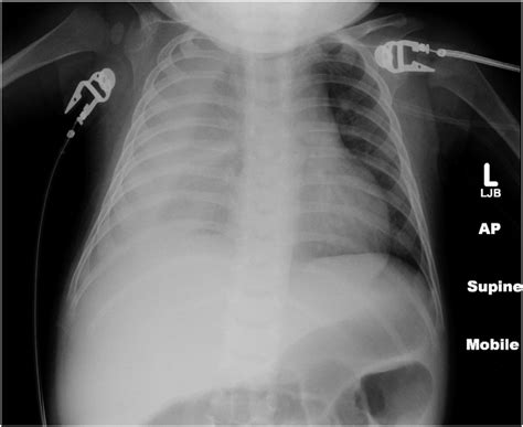 Cxr On Presentation Showing A Large Right Sided Pleural Effusion With