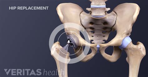 What To Expect After Hip Replacement Surgery