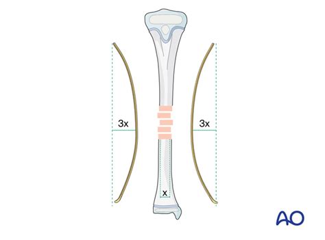 Elastic Nailing For Simple Transverse Tibial Fracture