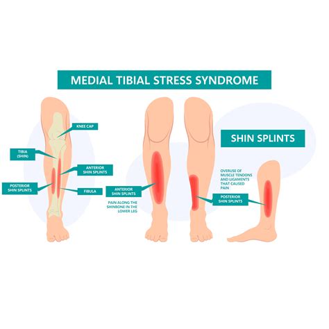 Shin Splints Medial Tibial Stress Syndrome Liz Tough Clinic