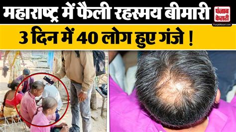 Maharashtra Viral News महाराष्ट्र में फैली अजीब बीमारी अपने आप गंजे