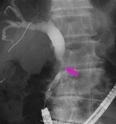 Cholangiographic View Of The Lesion Showing A Defect In The Distal Bile