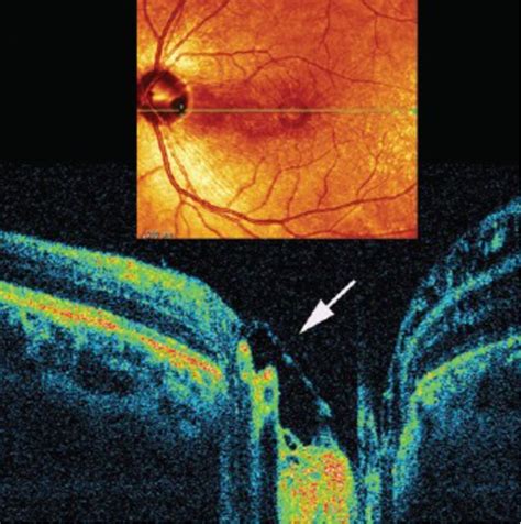 A Guide To Optic Disc Abnormalities With Cheat Sheet