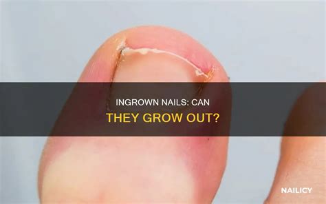 Ingrown Nails Can They Grow Out Nailicy