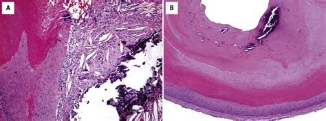 Cysts And Sinuses Clinical Tree