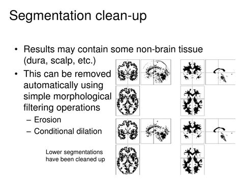 Ppt Voxel Based Morphometry With Unified Segmentation Powerpoint
