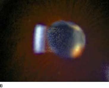 Anterior Uveitis Flare Cells
