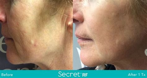 Secret Rf Microneedling Laser East Medspa