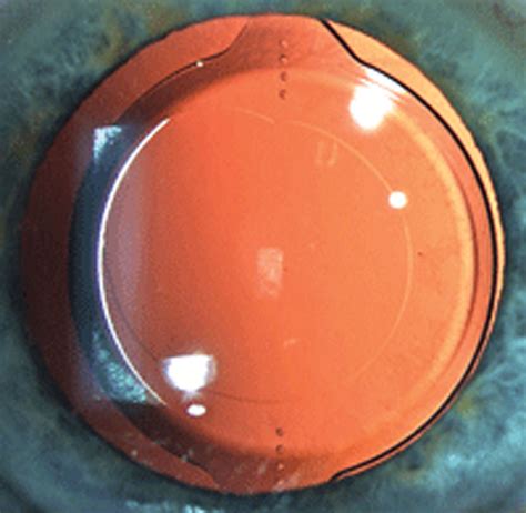 Toric Iols Edge Past Fsak In Moderate Astigmatism Correction