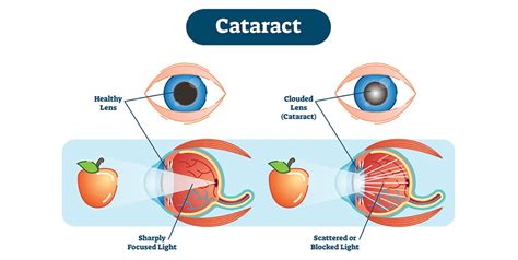 Types Of Cataract Surgery And Knowing Your Options Irisvision