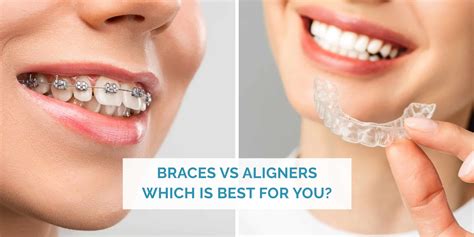 Braces Vs Aligners Which Is Best For You
