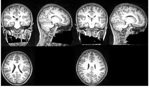 Two Structural Mri Images Highlighting That Differences In Brain