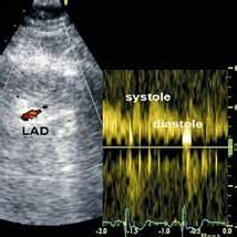 Biphasic Pulsed Wave Color Doppler Flow In The LAD Download Scientific Diagram